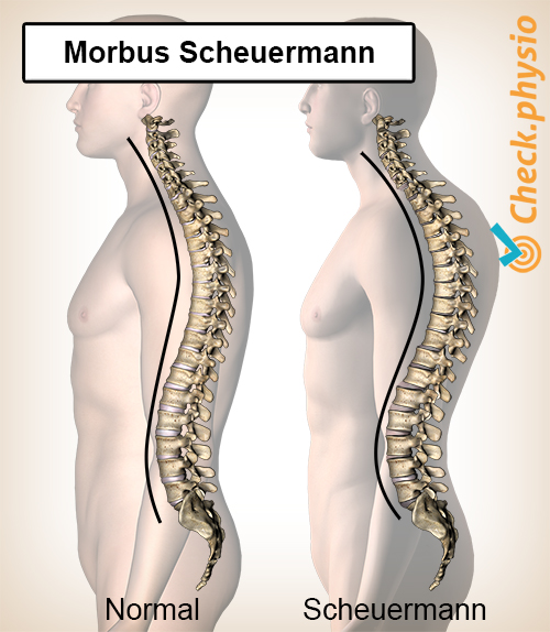 Morbus Scheuermann | Ursache, Symptome & Behandlung