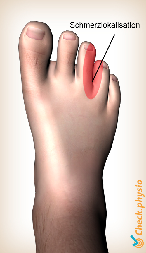 Ursache, Symptome & Behandlung | Morton-Neurom - Physiotest.at