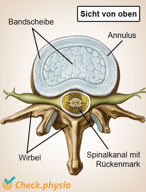 Lumbosakrales Radikuläres Syndrom (Bandscheibenvorfall)